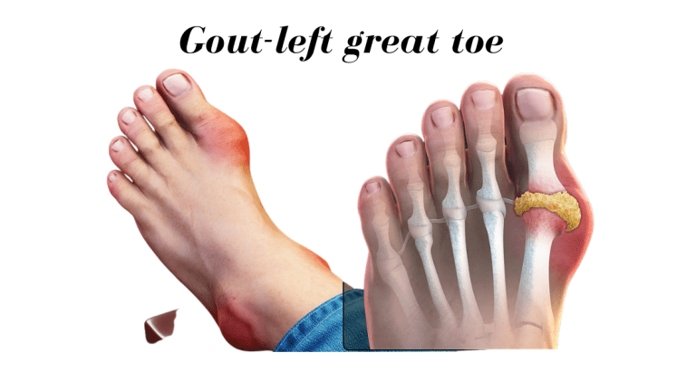 Gout- 8 Things You Need To Know To Prevent And Treat It