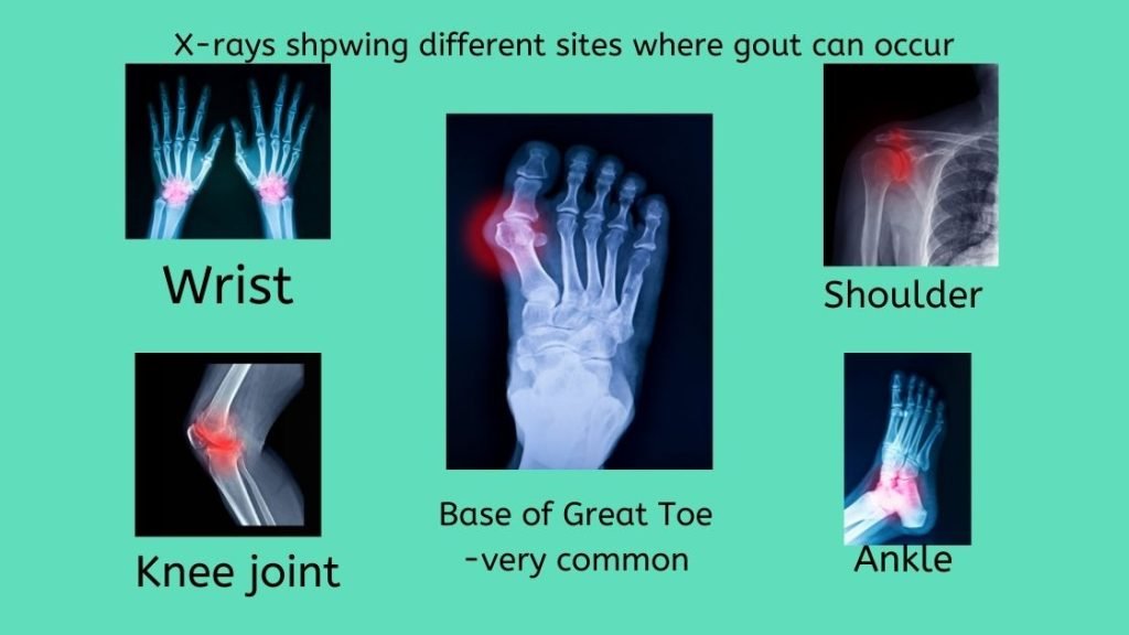 Gout- 8 Things You Need To Know To Prevent And Treat It