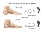 Do You Have Hallux Valgus? Learn How To Live With It