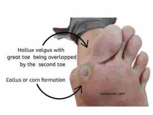 Do You Have Hallux Valgus? Learn How To Live With It