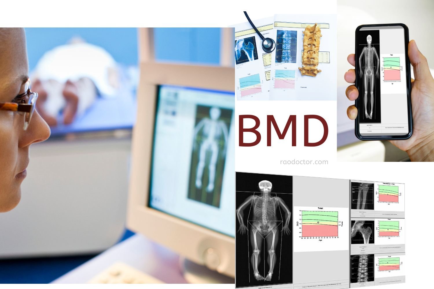 What Is Bone Mineral Density- How It Is Done And What To Look Out For