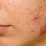 5 Common Skin Disease One Should Know About
