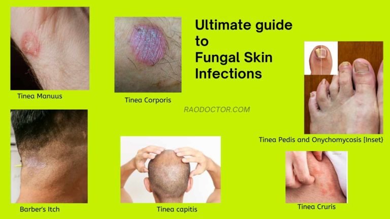Ultimate Guide To Fungal Skin Infections-How To Tackle Them