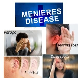 Diseases Of Internal Ear-Part 2-Vertigo And Meniere's Disease