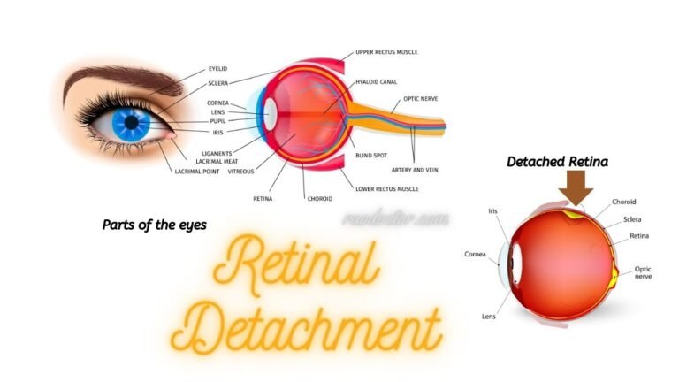 Understanding Retinal Detachment: Causes, Symptoms, And Treatment Options